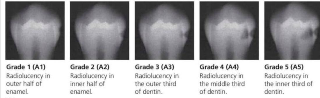 When to fix my caries? | Preventive Care Lewisville, Flower Mound ...