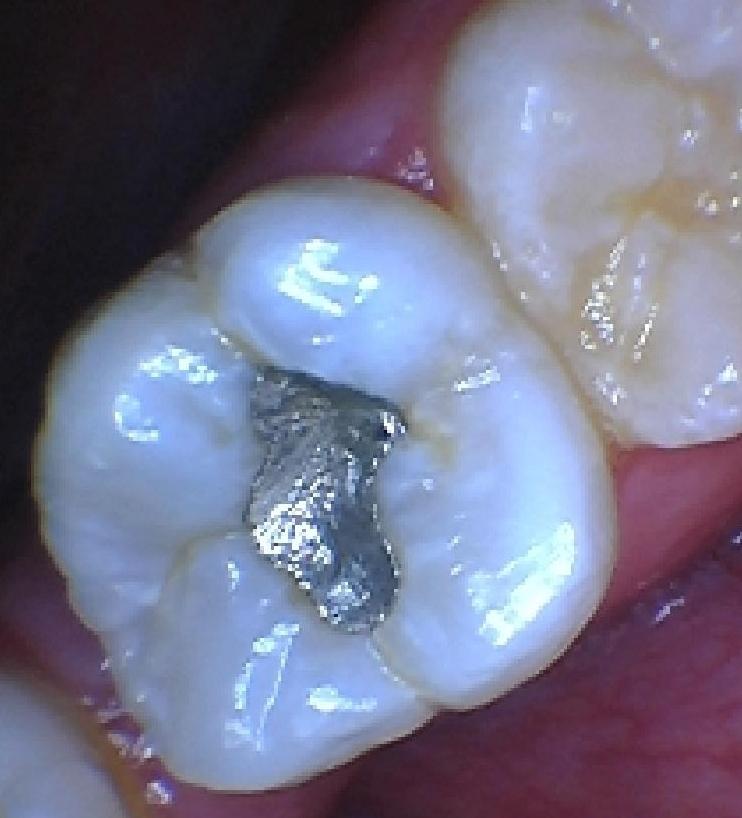 Why do I have to replace those existing fillings? | Fillings (White ...